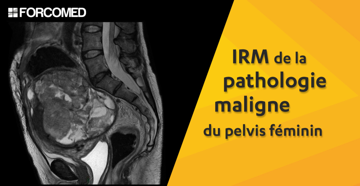IRM de la pathologie maligne du pelvis féminin - FORCOMED